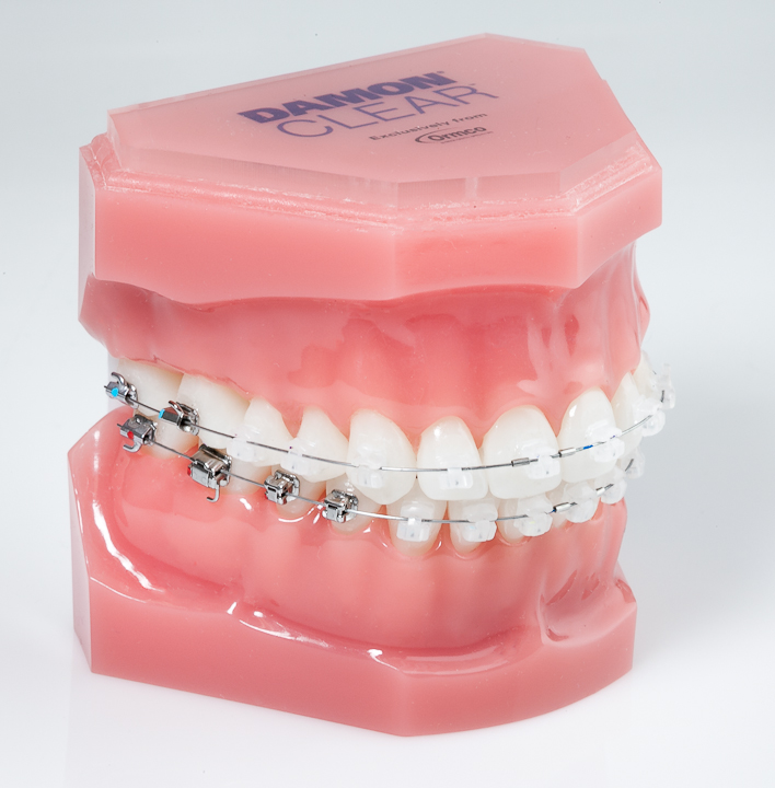 Clear Braces | Clinebell & Anderson Orthodontics
